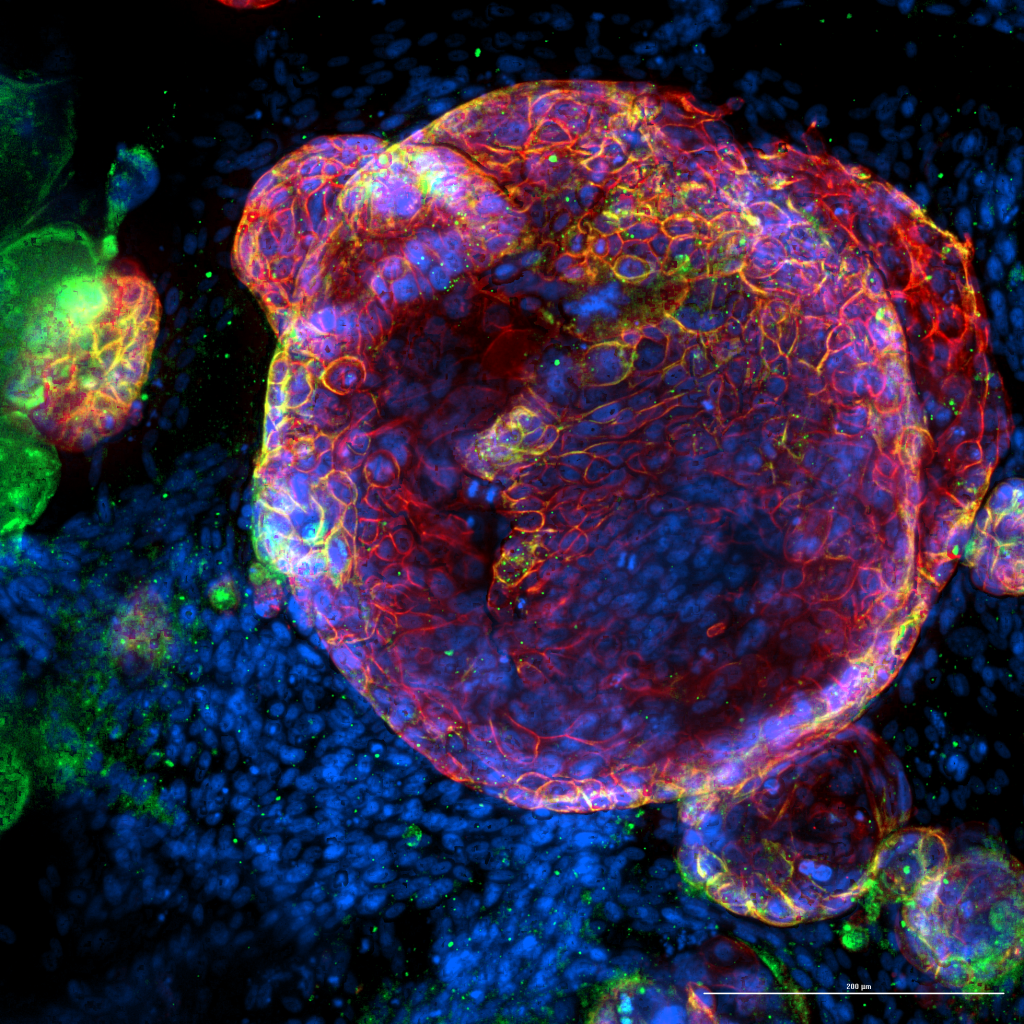 Tumor Biology - Research area I University of Luxembourg